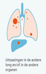 Longkanker - Máxima Oncologisch Centrum
