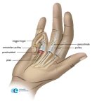 Triggervinger - Orthopedie